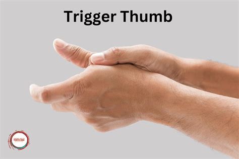 Understanding Trigger Finger and Trigger Thumb: Symptoms, Causes, and Treatment | Central Health ...