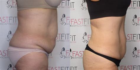 Fast Fit Pictures – Fast Fit Body Sculpting