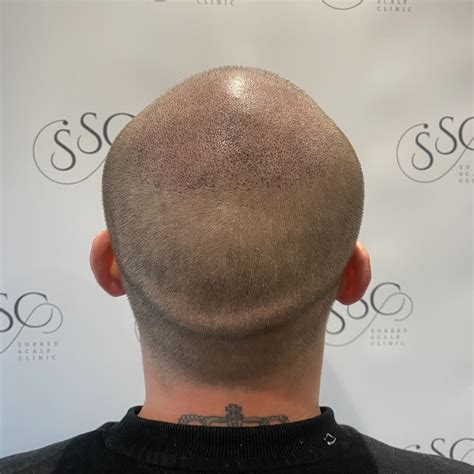 PHOTO GALLERY | Surrey Scalp Clinic