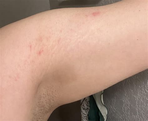 Rash around armpits : r/DermatologyQuestions