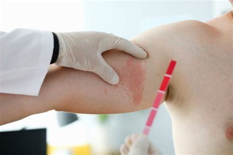 Основные препараты от крапивницы у взрослых | MedAboutMe