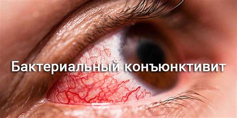 Бактериальный конъюнктивит: как справиться с симптомами