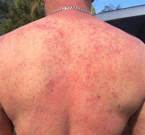 Mild Nummular Eczema