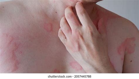7,337 Urticaria Images, Stock Photos, 3D objects, & Vectors | Shutterstock