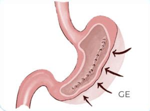 La gastroplastia endoscópica en manga induce y mantiene la pérdida de ...