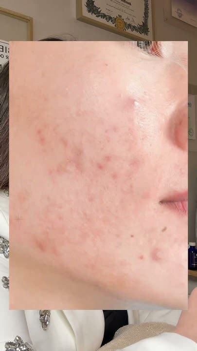 Мицелляркой нужно уметь пользоваться. #косметологсша #акне # ...