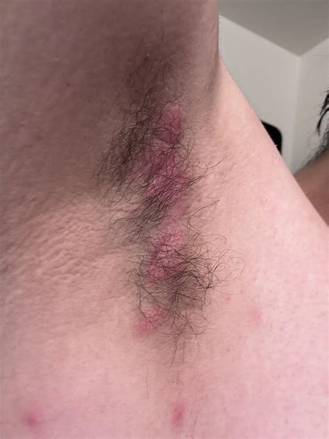 Can someone tell me what this rash is on my armpit i think it’s cause ...