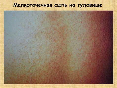 Атлас - стрептококковая инфекция - презентация онлайн