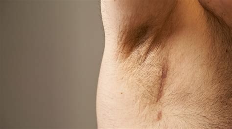 Understanding Swollen Lymph Nodes in Armpit and Their Causes