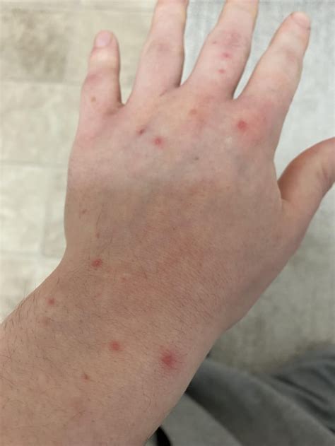 I’ve been getting these all over my arms the last couple of weeks, I’ve been suffering with ...