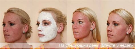 Пилинг Джесснера: что это такое, как наносить, уход после процедуры ...