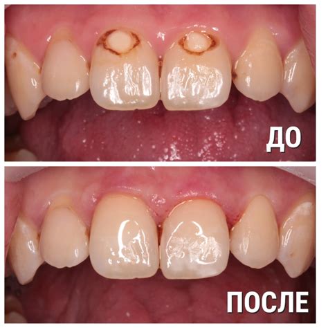 Несъемное протезирование в Кирове