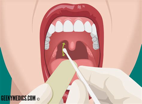 Oropharynx Swab Oropharyngeal Cancer: Diagnosis, Stages & Treatment