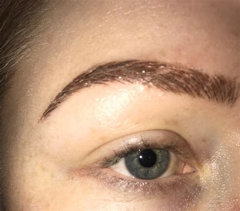Pimples Around Eyebrows