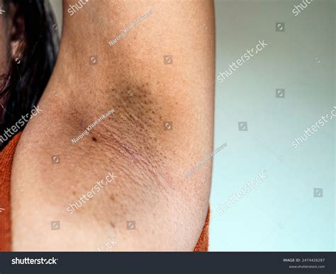 Стоковая фотография 2474426287: Close-up Women Armpit Problem Black Armpit | Shutterstock