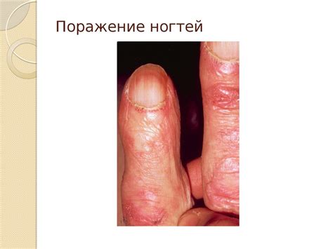 Дерматомиозит - презентация онлайн
