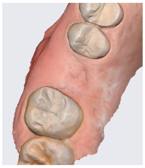 The Use of Nano-Hydroxyapatite (NH) for Socket Preservation ...