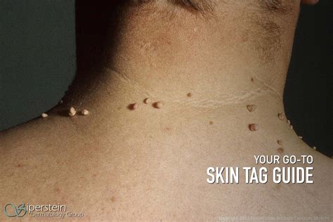 Multiple Skin Tags On Neck