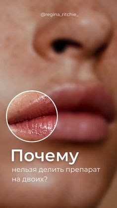 Косметолог . Что такое филлеры . Идеи сторис косметолог