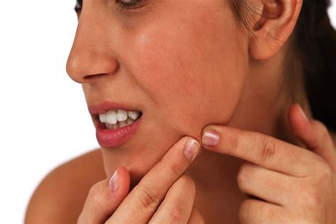 Почему нельзя давить прыщи — GALAXYDERM