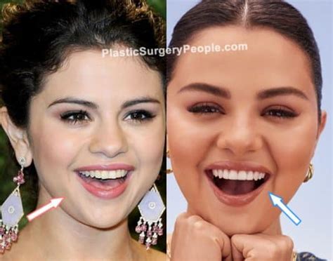 Selena Gomez: BEFORE and AFTER 2022