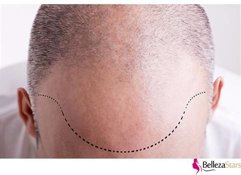 Hair Restoration Procedure - Beauty Machine Supplier