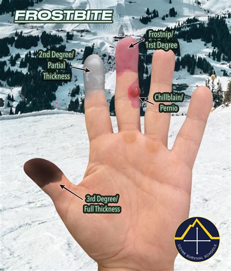 Photos Of Frostbite: A Visual Guide To The Dangers Of Cold Exposure