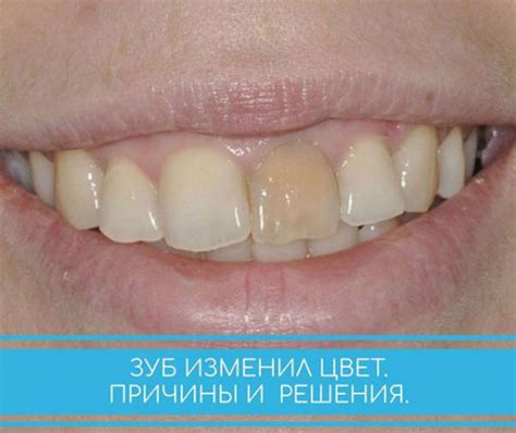 Зуб изменил цвет / Эстетическая реставрация / Блог