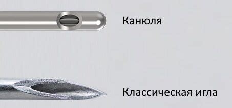 Что такое Канюля | NEOPLASTY