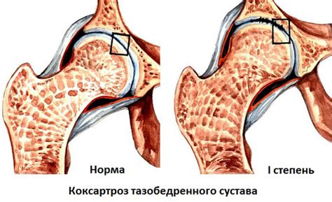 Коксартроз тазобедренного сустава: симптомы, причины, степени