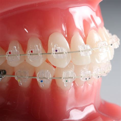 Эстетическая ортодонтические скобы - Vapor™ - G&H Orthodontics - из ...
