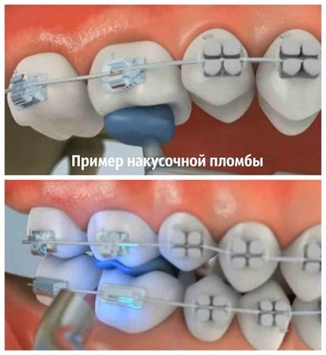 Надкусочные пломбы для зубов