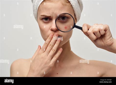 woman with a pimple on the face dermatology isolated background Stock Photo - Alamy