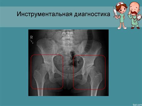 Дисплазии тазобедренных суставов - презентация онлайн