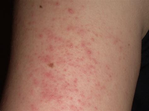 What Does Keratosis Pilaris Look Like? – Balmonds