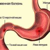 Слабительные средства при запорах, таблетки от запора | Азбука здоровья