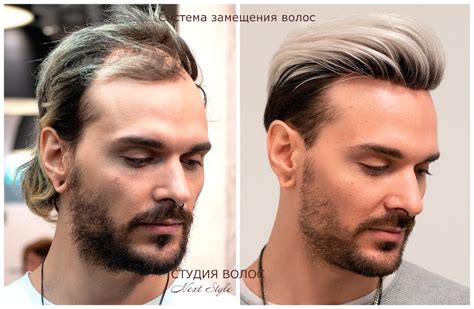 Система замещение волос в Москве | Студия волос NEXT STYLE