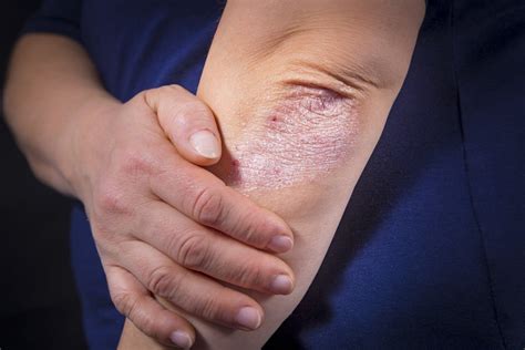 Можно ли добиться длительной ремиссии при псориазе? | MedAboutMe