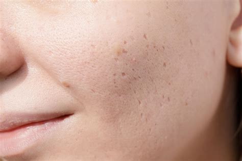 Premium Photo | Young woman suffering from problem skin and acne ...