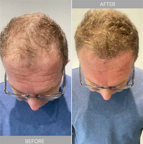 PHOTO GALLERY | Surrey Scalp Clinic