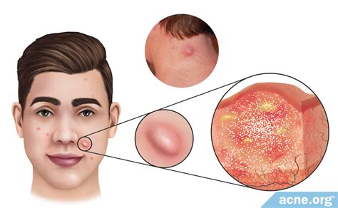 Skin Nodule Acne