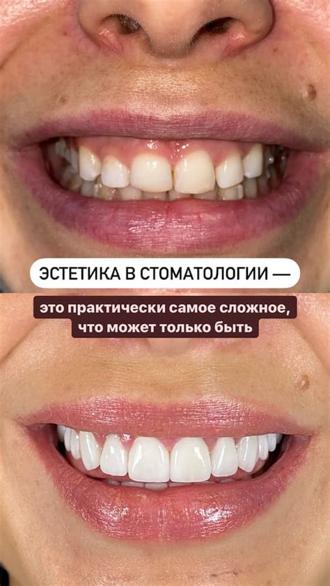 Виниры: виды, особенности установки, безопасность, показания и ...