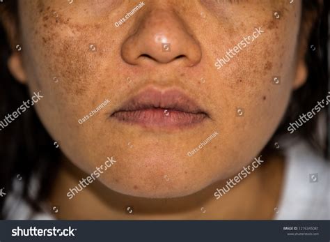 4,261 Hyperpigmentation Skin Images, Stock Photos & Vectors | Shutterstock