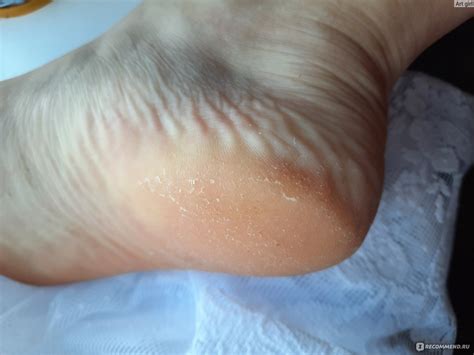 Пилинг для ног Белита-Витэкс Ultra Foot Care кислотный для размягчения ...