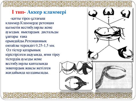 Кламмер жүйесі - презентация онлайн