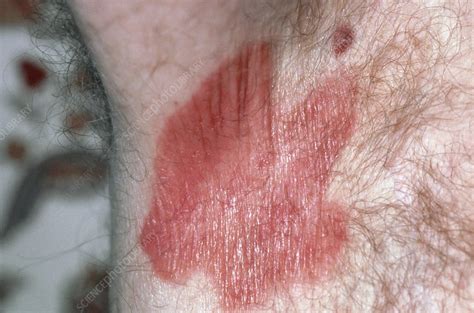 Red Rash And Bumps Under Armpit at Harold Hernandez blog