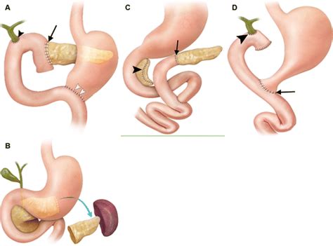Imaging after Pancreatic Surgery: Expected Findings and Postoperative ...