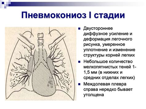 Общие понятия о пылевых болезнях легких. Пневмокониозы - презентация онлайн