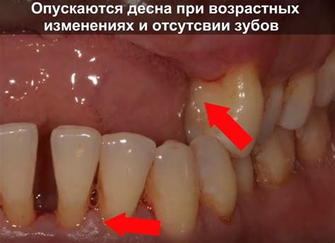 Как выглядит десна на 5 день после удаления зуба фото