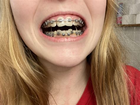 3rd visit, power chains on top & wires put through all the brackets on the front of the bottom ...